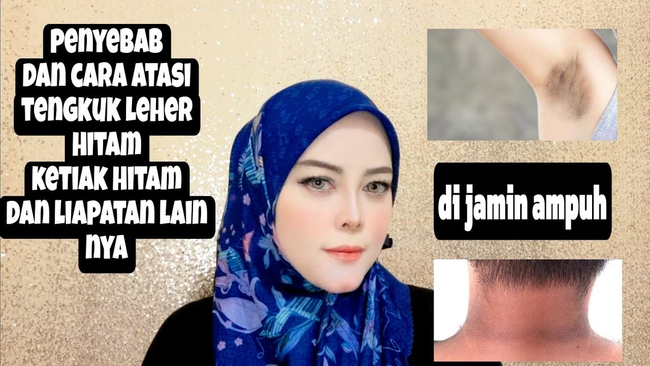 Penyebab Dan Cara Mengatasi Lipatan Hitam Di Leher | Cara Memutihkan ...