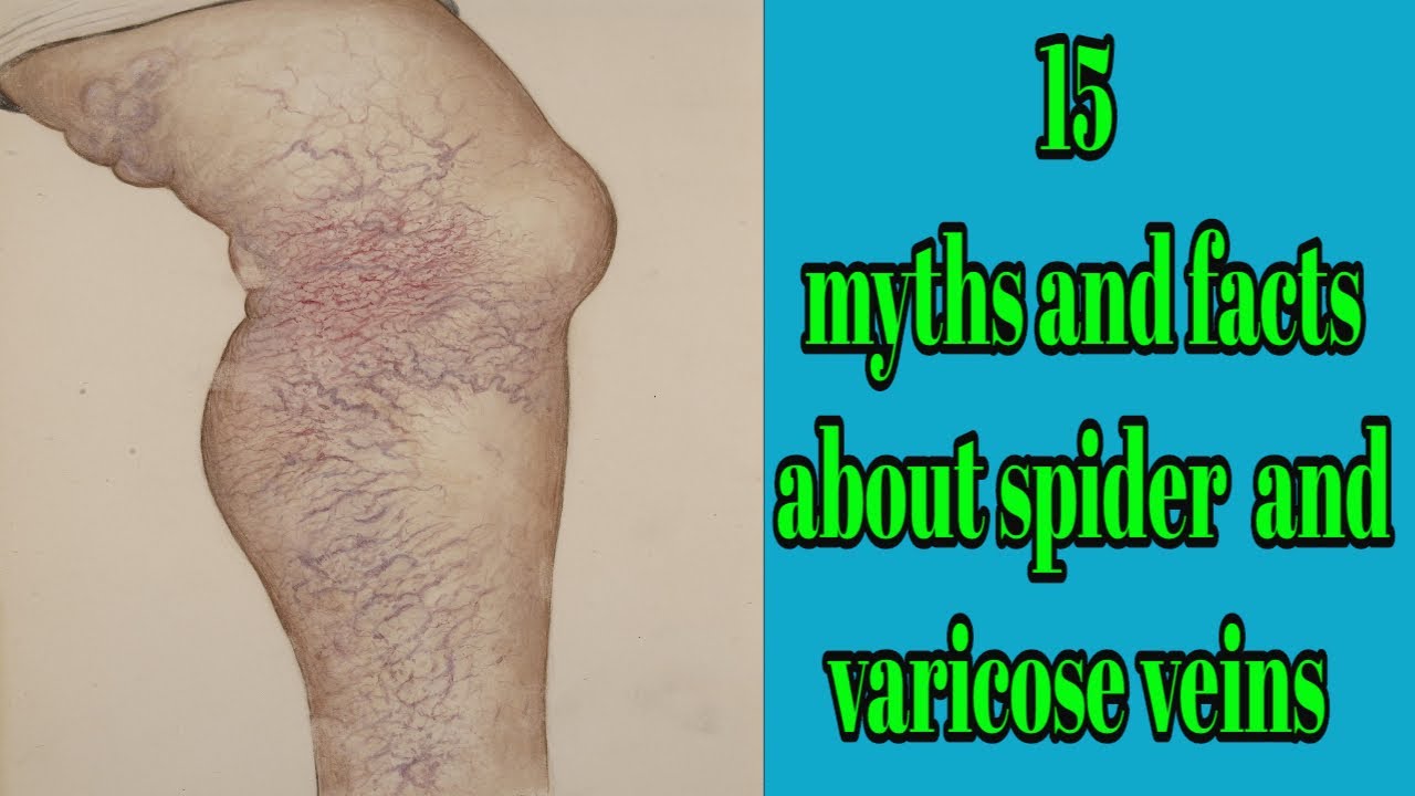 15 myths and facts about spider and varicose veins. - YouTube