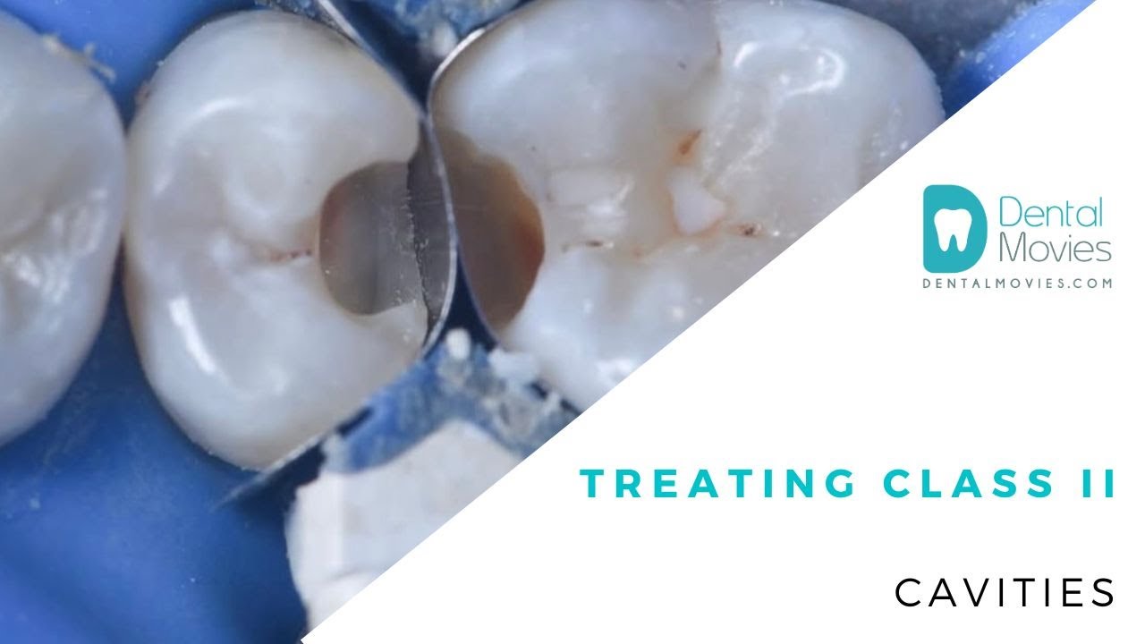Treating class II cavities - YouTube