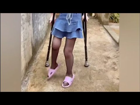 The beautiful girl has polio, the challenge of disability, a happy life ...