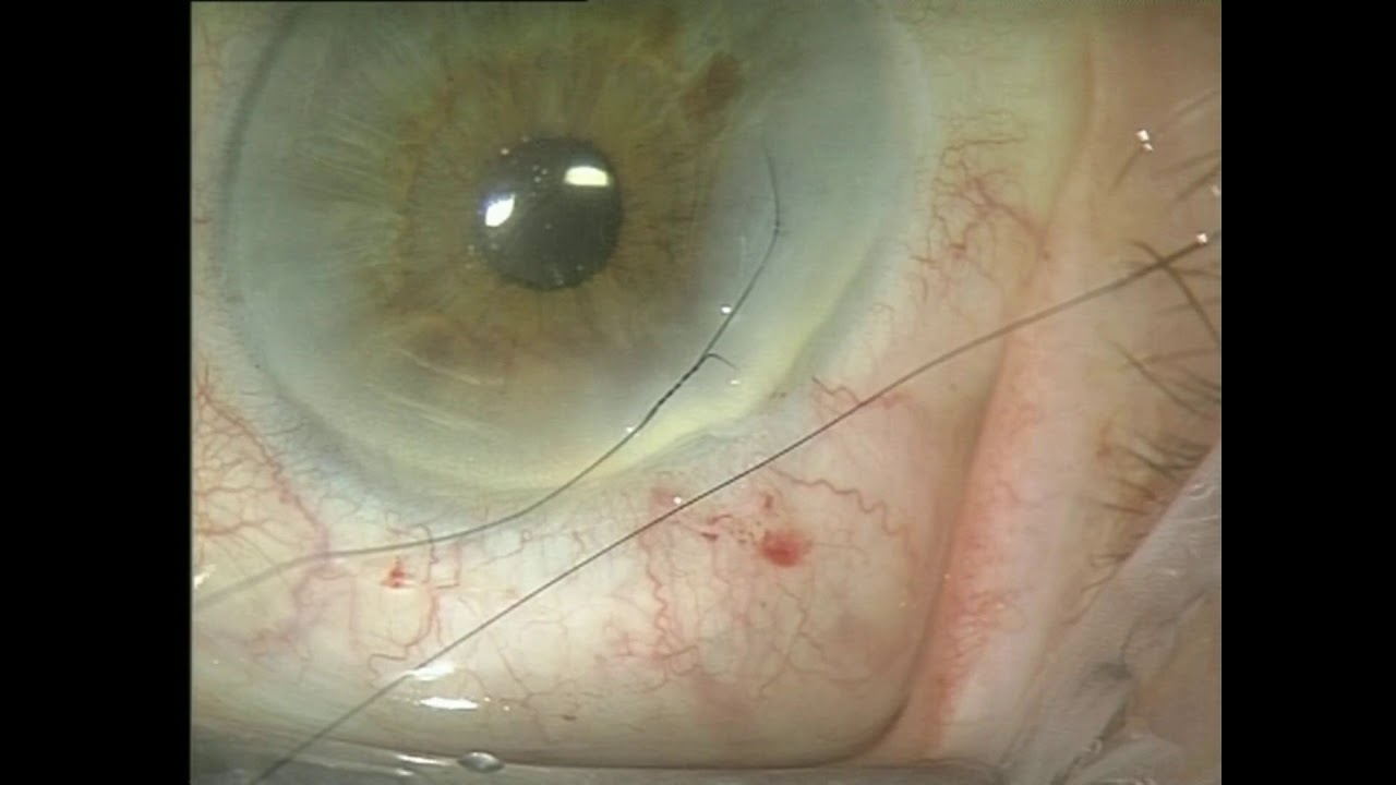 How to suture a corneal burn - YouTube