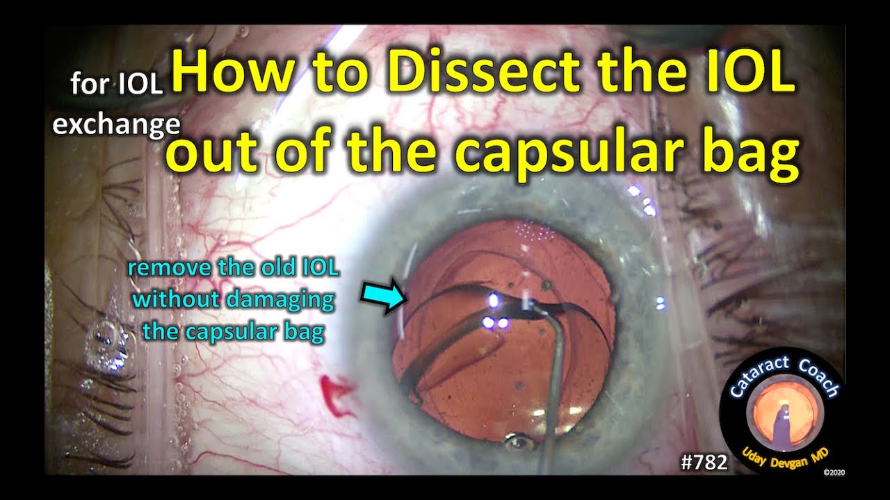 how to dissect the IOL out of the capsular bag for IOL exchange - YouTube