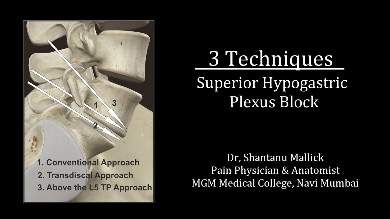 Superior Hypogastric Plexus Block (3 Techniques) - YouTube