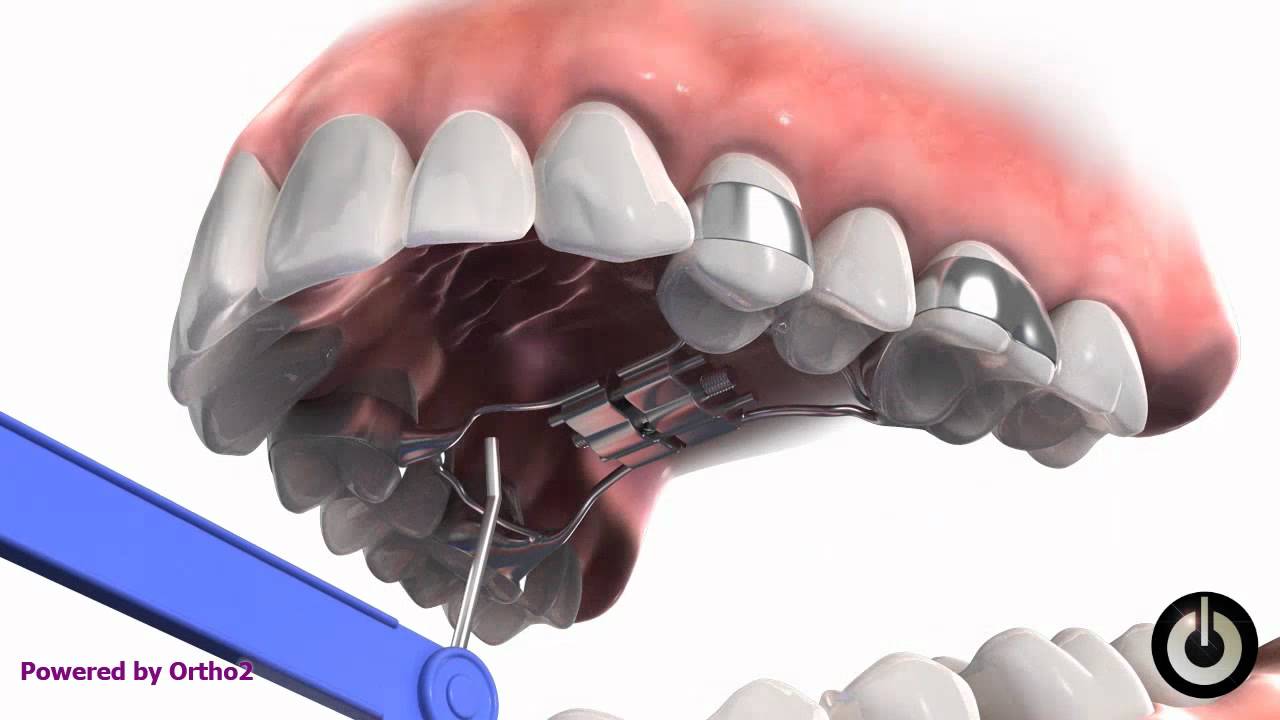 Appliance- RPE - YouTube