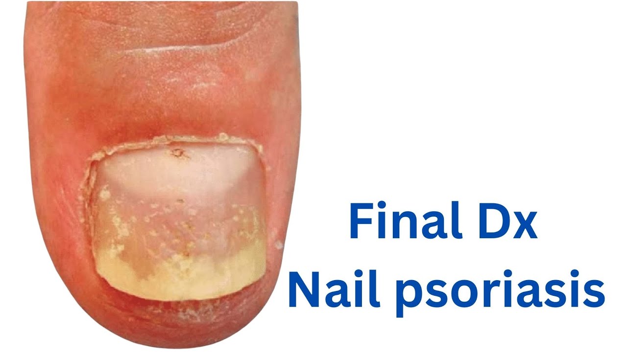 Nail Psoriasis: Recognizing Nail Pitting, Onycholysis, and More! - YouTube