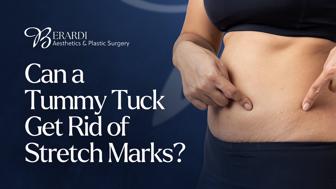 Can a Tummy Tuck Get Rid of Stretch Marks? | With Dr. Joseph Berardi ...
