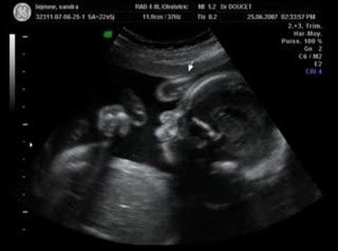 Echo morphologique et 3d de Vicky 25-06-07 - YouTube