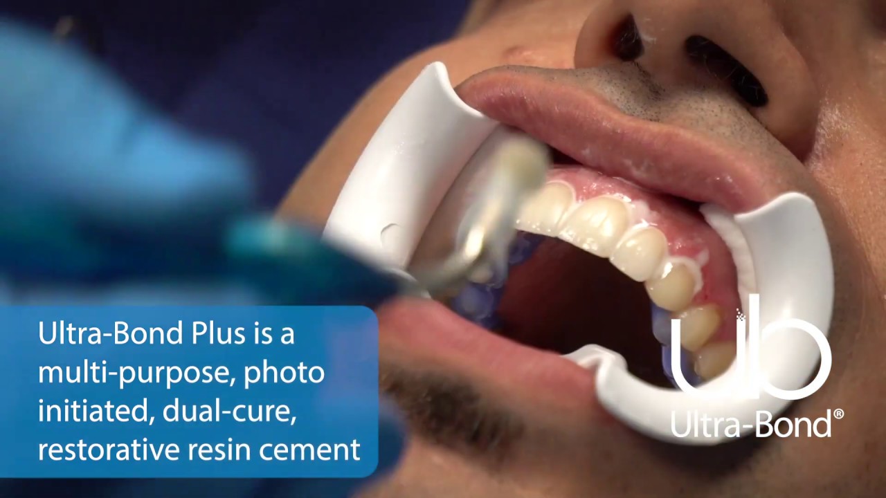 Ultra-Bond Plus® - 30-Second Dentistry™ - Patient: Kaveh - YouTube