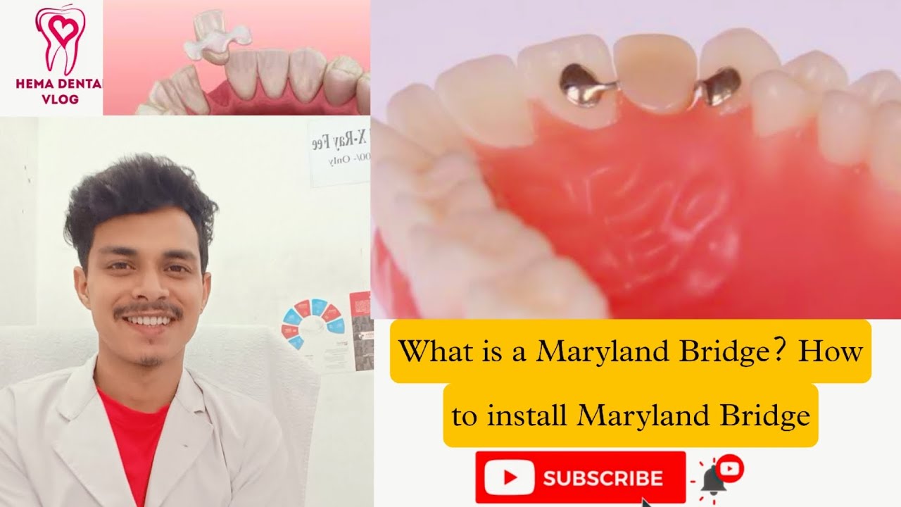 What is a Maryland Bridge? How to install Maryland Bridge #dental # ...