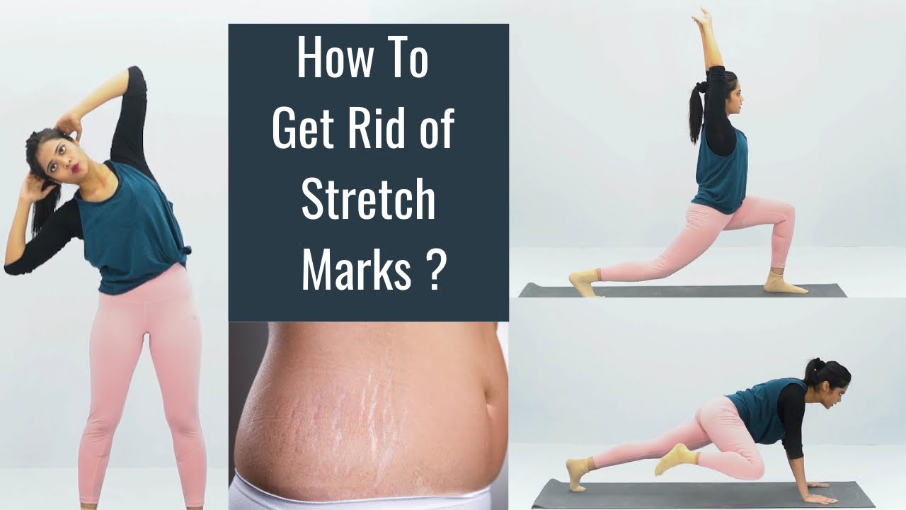 How To Get Rid Of Stretch Marks On Legs