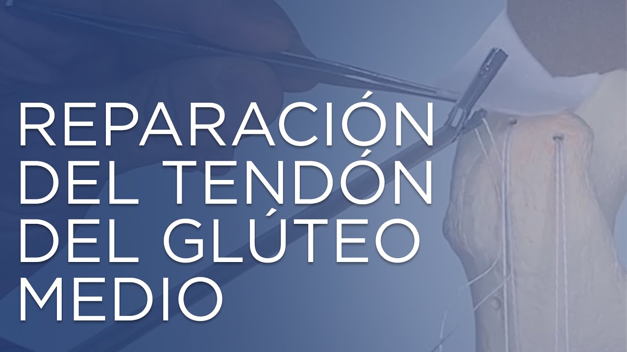 Reparación del tendón del glúteo medio - YouTube
