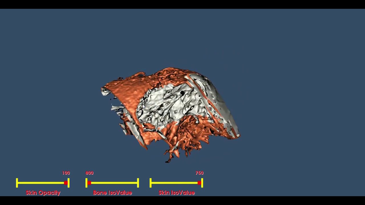 VTK Shoulder Reconstruction - YouTube