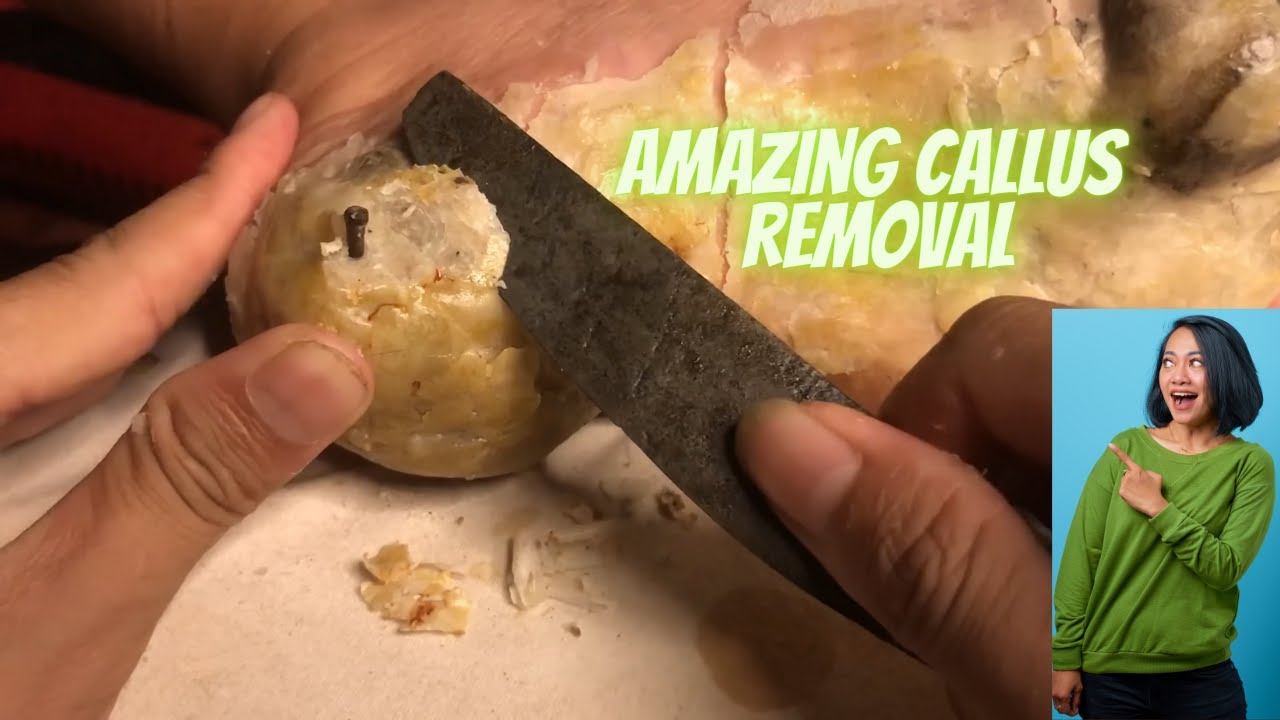 CALLUS REMOVAL SKIN FLAKES, How to removal skin. Relax Video - YouTube
