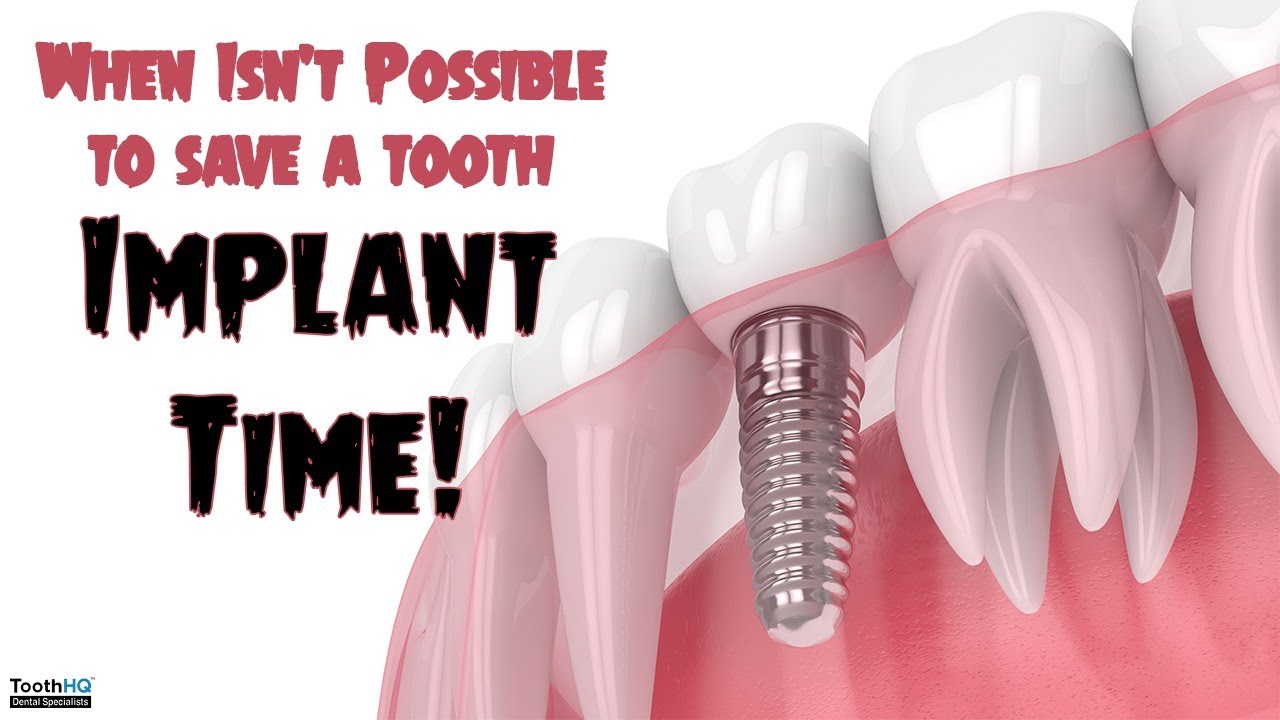 When Isn't Possible to save a tooth - Implant Time! - YouTube