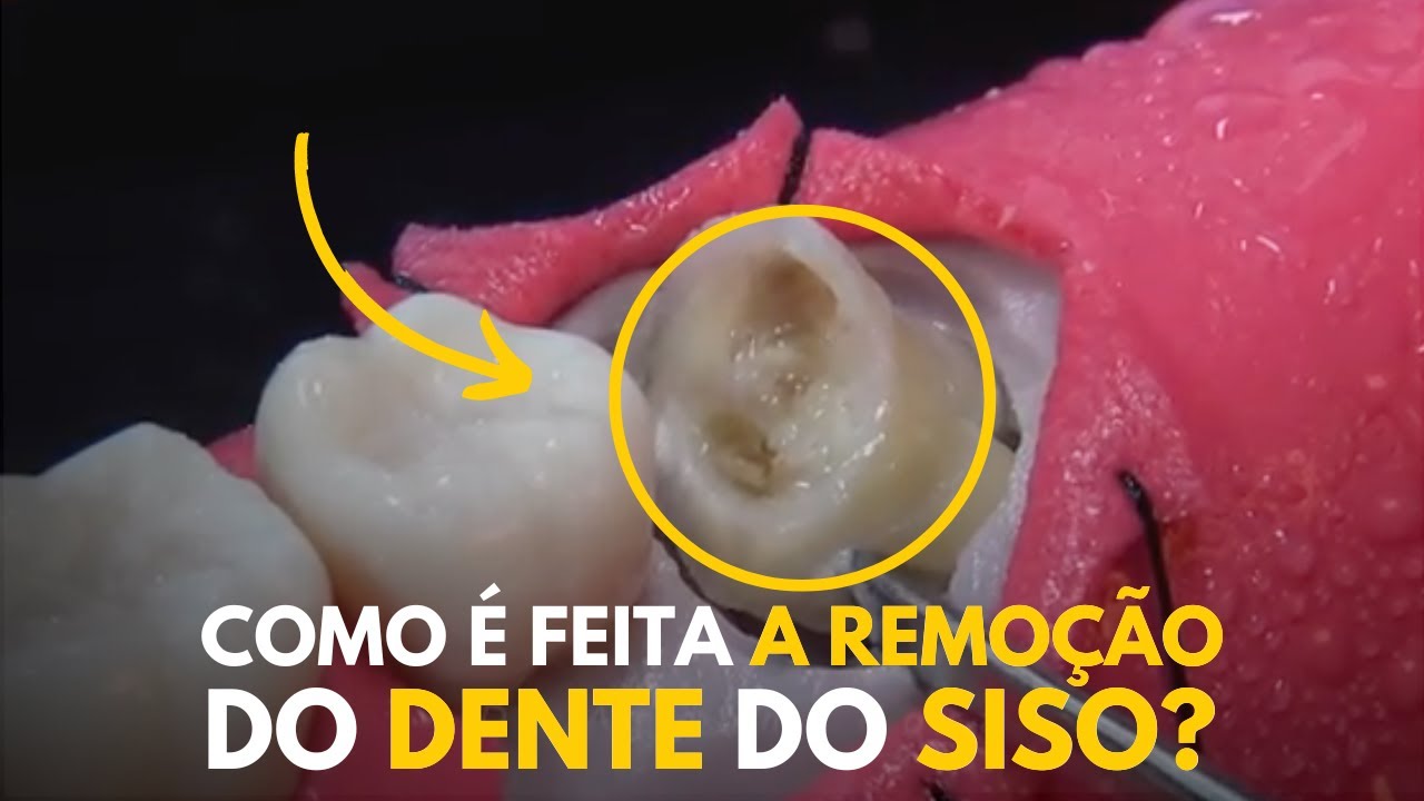 COMO É FEITA A REMOÇÃO DO DENTE DO SISO? Dr Ronaldo Leite - YouTube