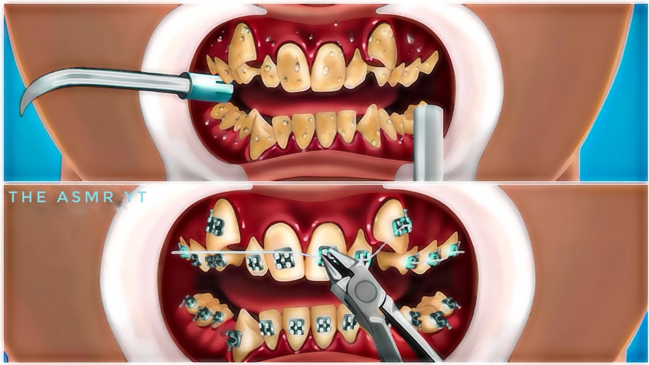 teeth treatment asmr video #asmr #viral - YouTube