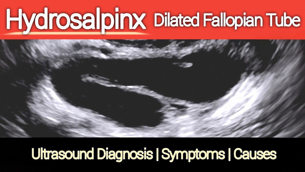 Unilateral Fallopian Tube Blockage ( Hydrosalpinx ) Infertility ...