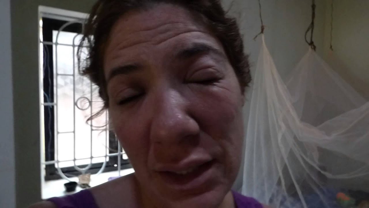 Swollen Alien Deformity & Toxins Released in Rash, Day 18 Healing ...