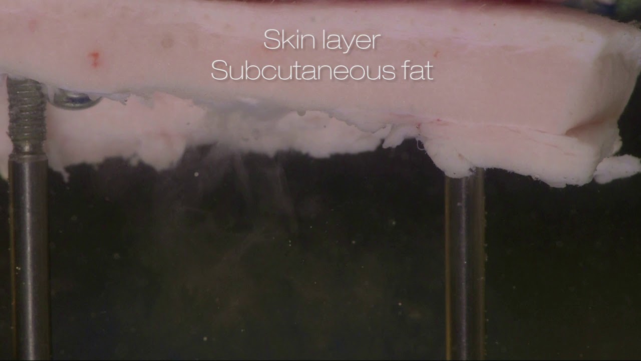 Ultrashape Fat destruction video using a porcine skin model - YouTube