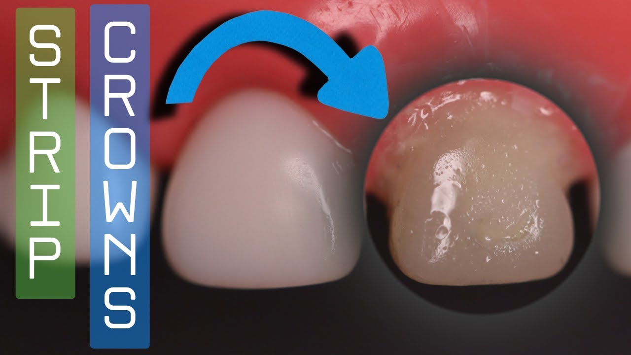 strip crowns ⚪️ step by step video 🔵 - YouTube