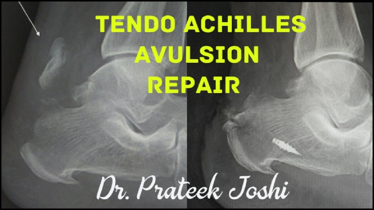 Achilles Tendon Avulsion Injury Repair with Suture Anchor | Dr. Prateek ...