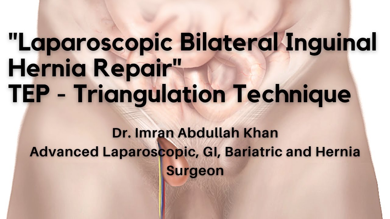 Laparoscopic Inguinal Hernia Repair Tep Triangulation Technique Dr