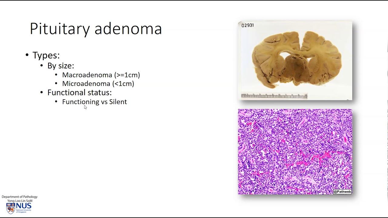 Pituitary Macroadenoma Histology