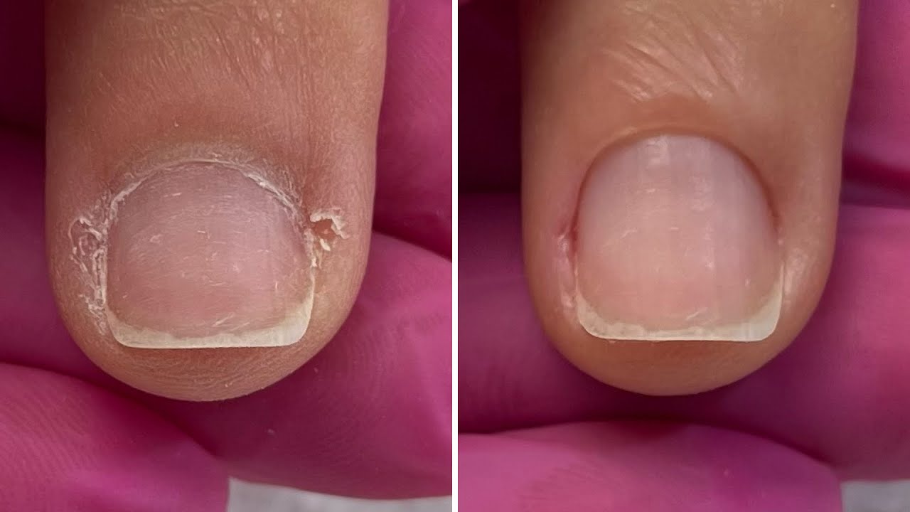 CUTÍCULA GRUDADA | COMO FAZER? - YouTube