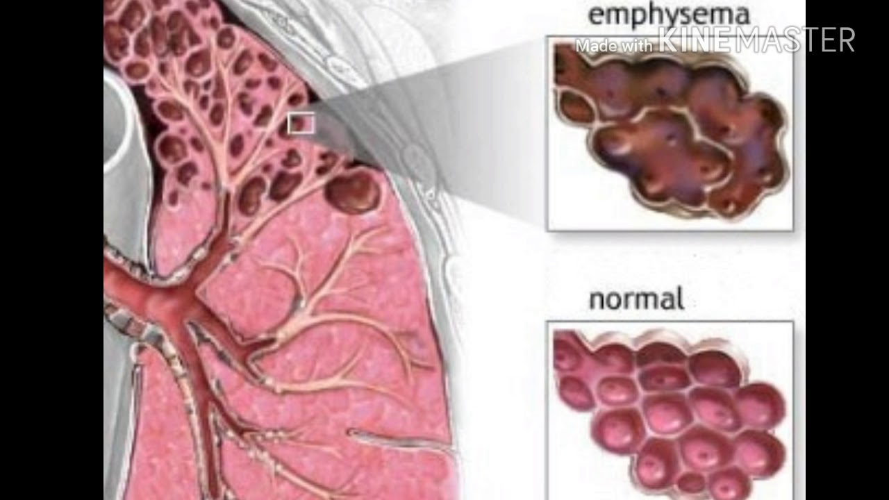 Emphysema - YouTube
