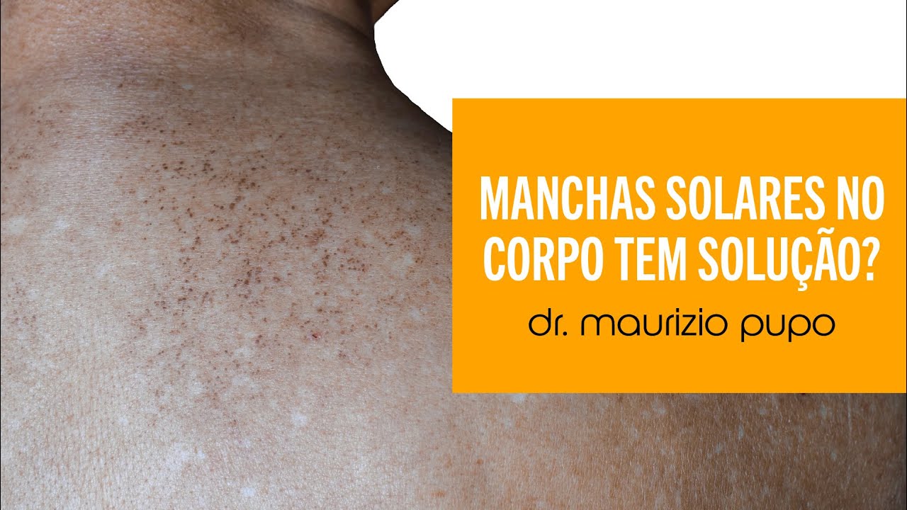 MANCHAS SOLARES NO CORPO TEM SOLUÇÃO? - Dr. Maurizio Pupo - YouTube