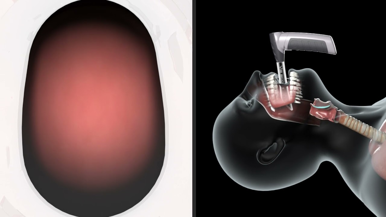 intubation animation 15 sec - YouTube