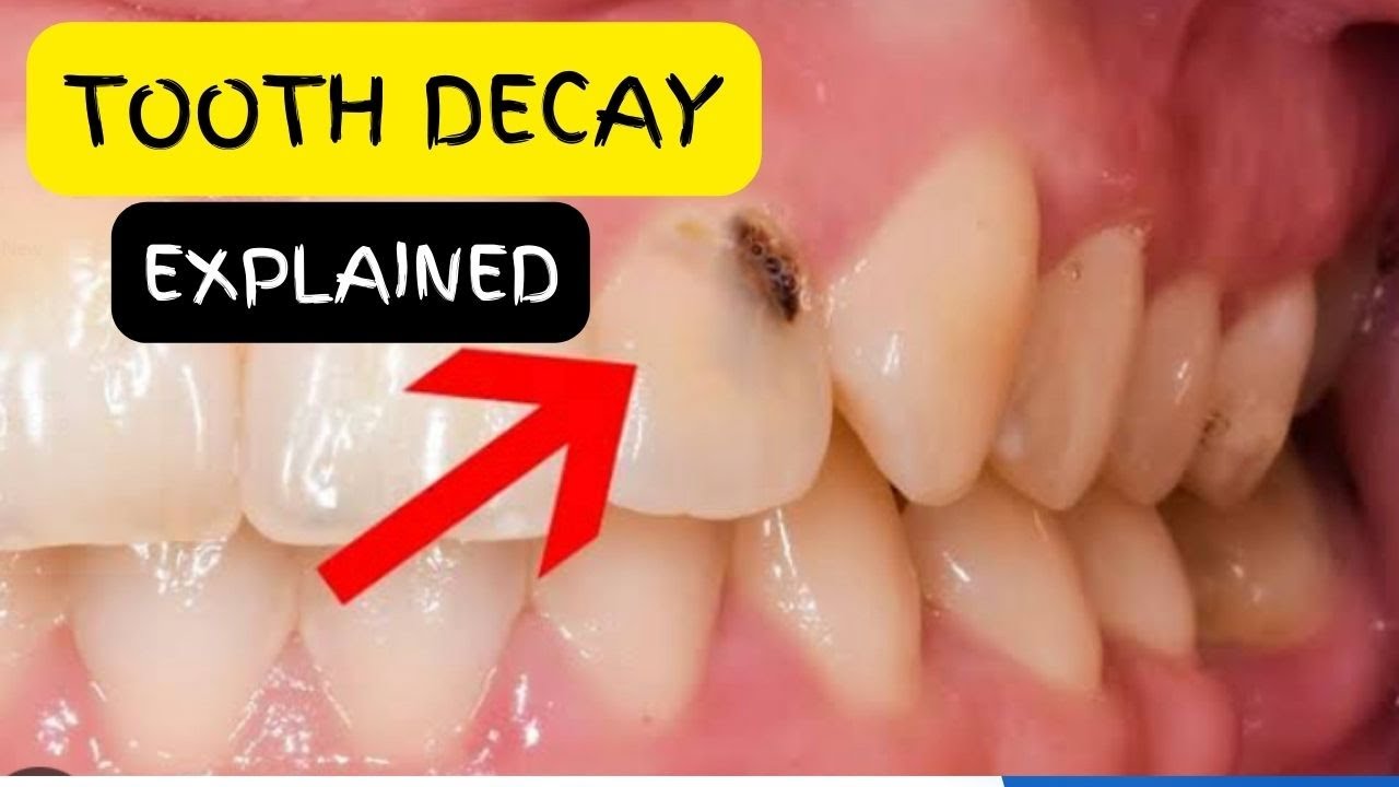 How To STOP TOOTH DECAY (Cavity) Dental Therapist Explains # ...