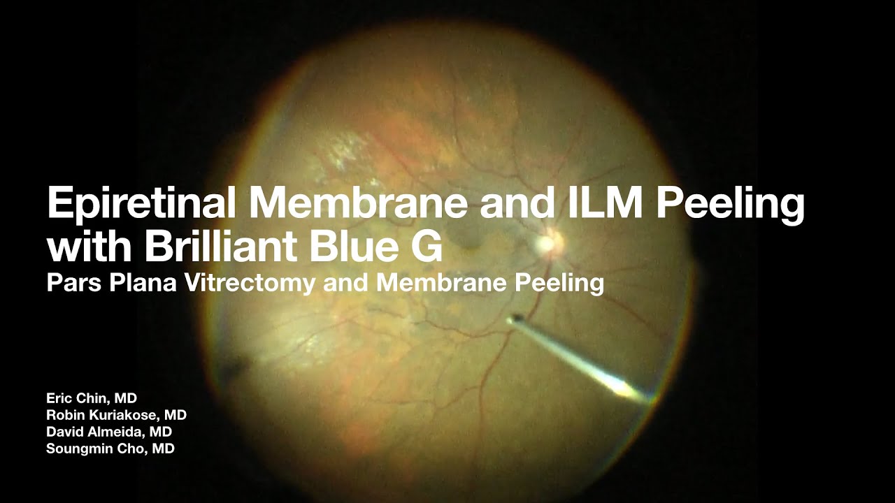 Epiretinal Membrane and ILM Peeling with Brilliant Blue G - YouTube
