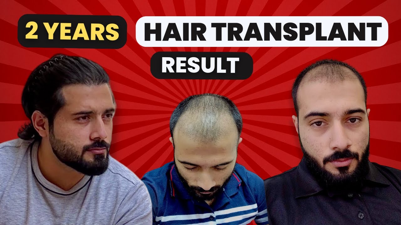 My 2 Years Turkey Hair Transplant Result & Review | Best Shampoo For ...