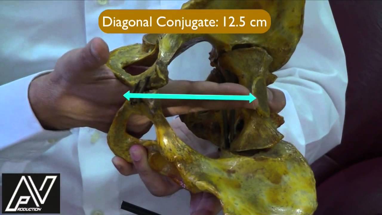 Diagonal Conjugate Pelvimetría Mediante Tomografía Computadorizada