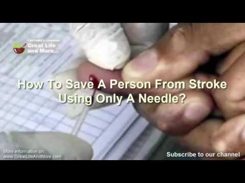 Treating stroke with pin pricks - YouTube
