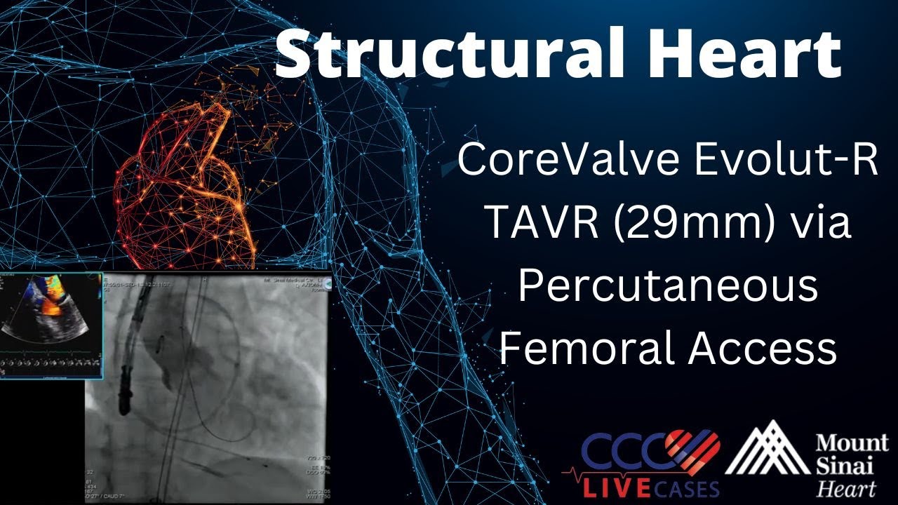 CoreValve Evolut-R TAVR (29mm) via Percutaneous Femoral Access ...
