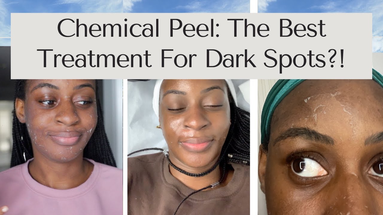 HOW I GOT RID OF MY ACNE SCARS! TCA Chemical Peel | Procedure + Before ...