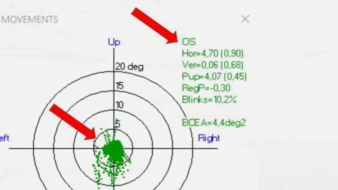 MonCvONE perimeter -2- Video imaging and eye movements - YouTube