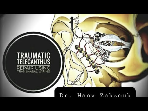 Management of traumatic telecanthus by medial canthopexy using ...