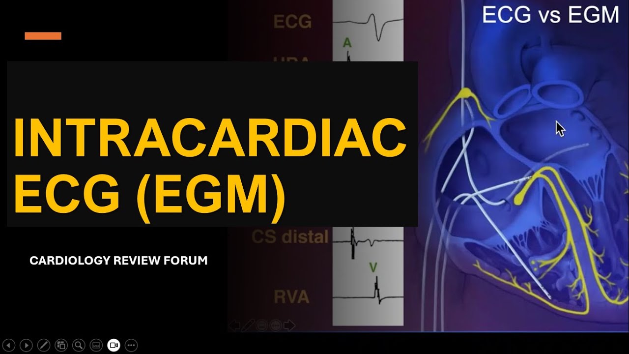 INTRACARDIAC ECG ( EGM ) - YouTube