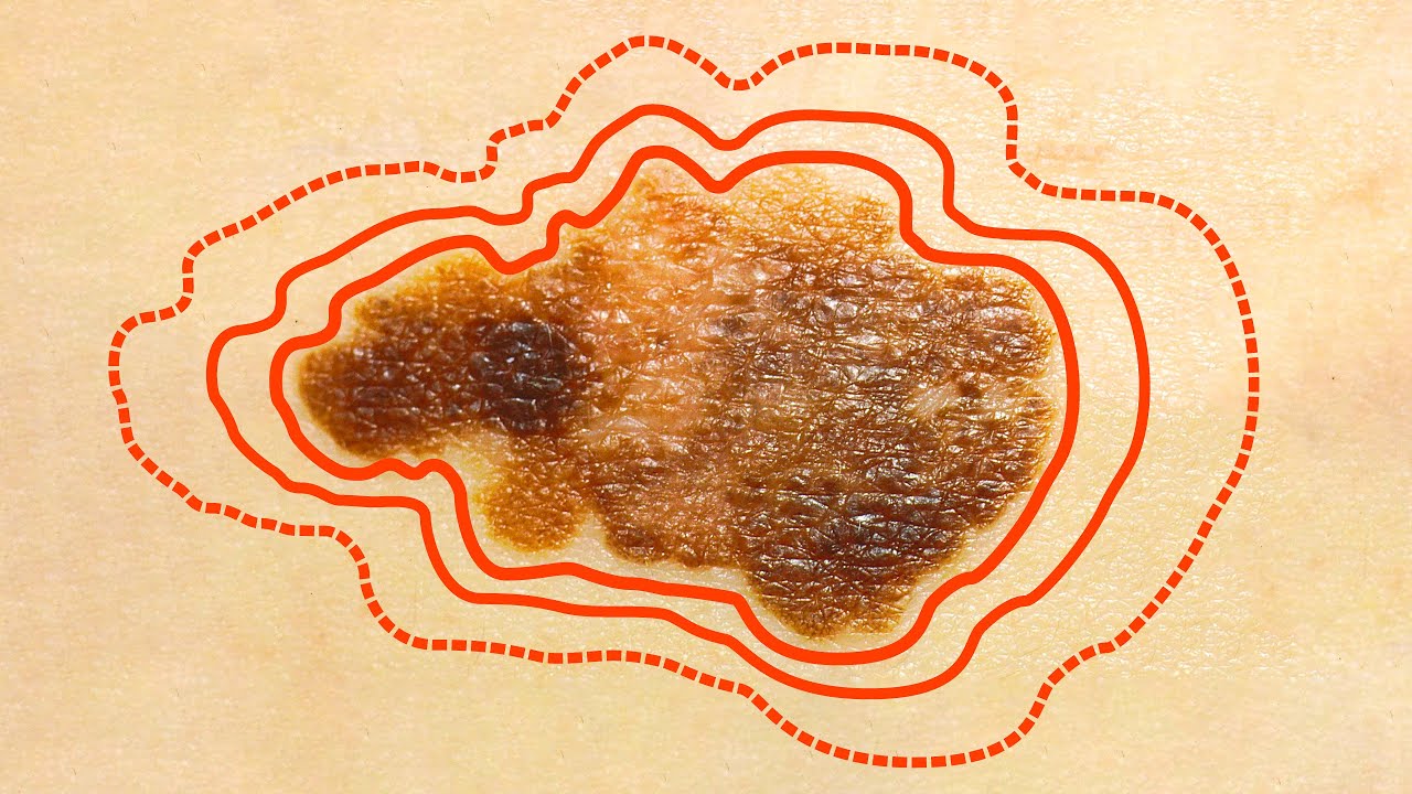 The Farmer Who Removed His Skin Cancer With A Pocket Knife - YouTube