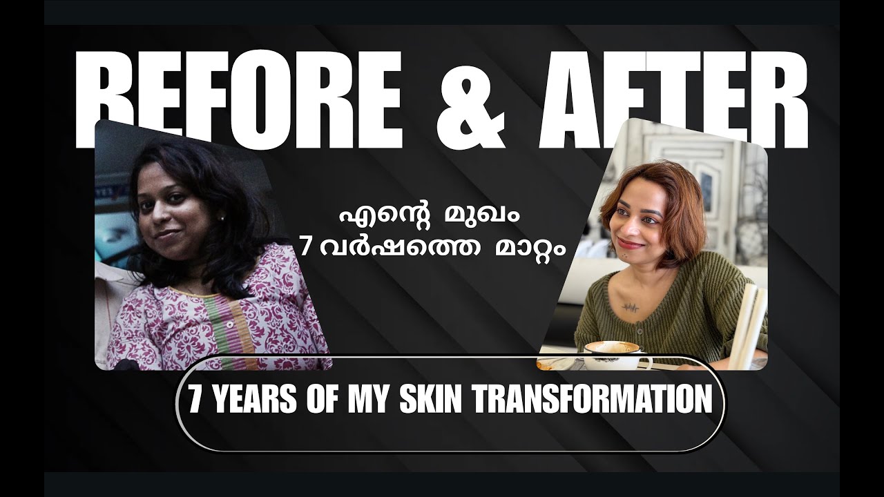 7 years skin transformation | ഏറ്റവും പവർഫുൾ ആയ സ്കിൻ കെയർ products ...