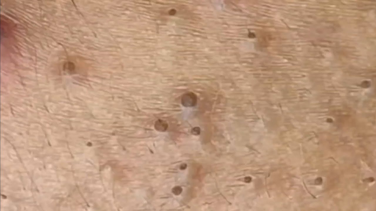 SATISFYING PIMPLES AND BLACKHEADS EXTRACTION - #31 - YouTube