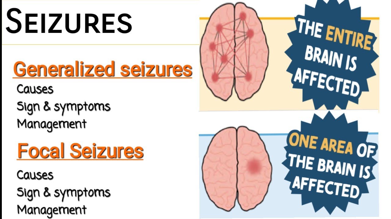 Seizures,Epilepsy | Types of Seizure | management of Seizures AHN neuro ...