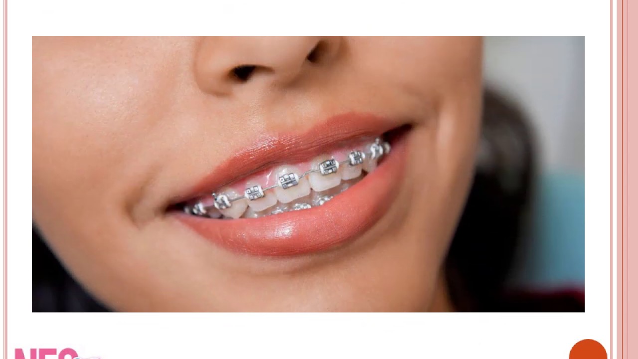 Which Type Of Care Required In Braces Surgery - YouTube