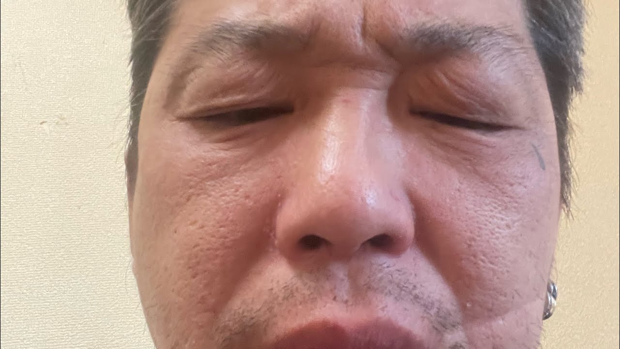 ブロック注射激痛‼️ヤバイ‼️少しはよくなりました‼️激ヤバイ‼️ Youtube