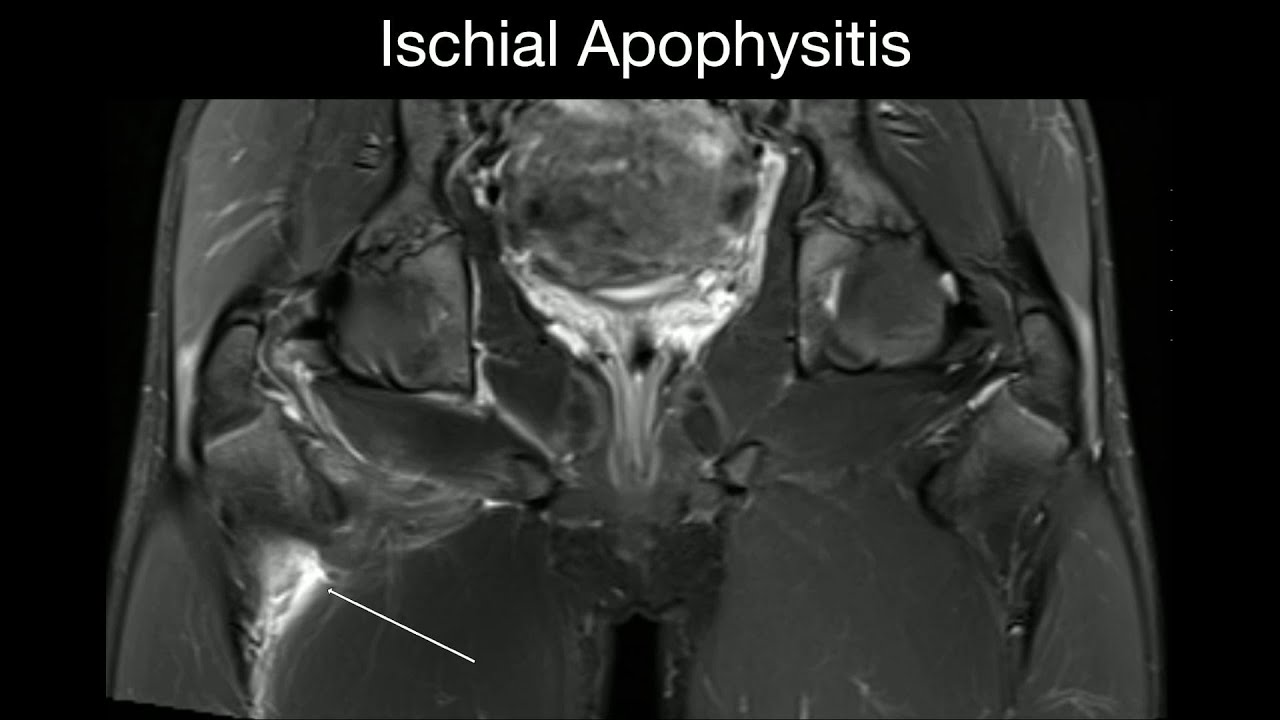 Ischial Apophysitis - YouTube