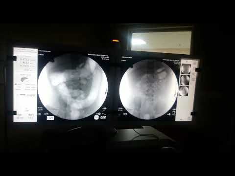 Pneumatic reduction intussusception - YouTube