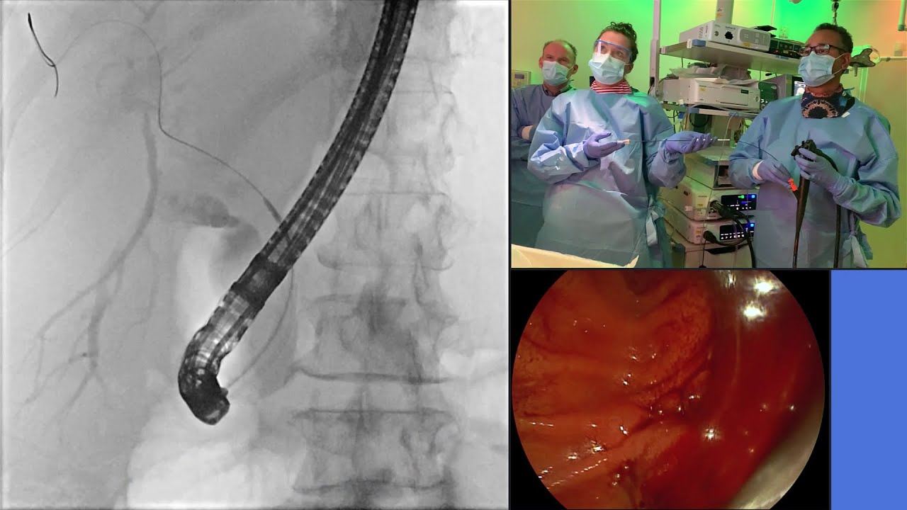 Tutorial: cannulating the difficult papilla & SEMS placement - YouTube
